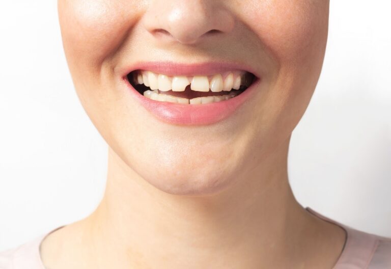 Effective Ways to Fix a Chipped Tooth at Dental Park